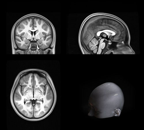 TI/tDCS时间干涉个性化计算刺激方案-Neuralstim个性化建模计算服务平台